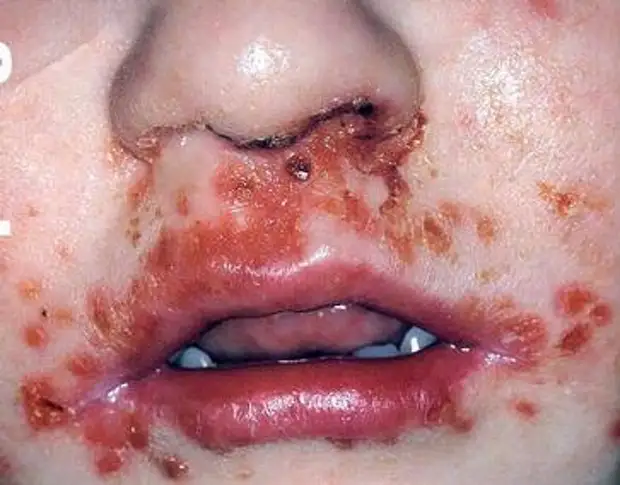 impetigo ਬਾਰੇ ਪੋਸਟ ਕਰੋ