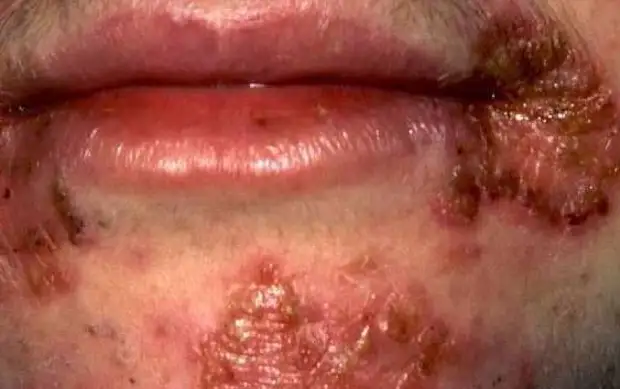 impetigo ਬਾਰੇ ਪੋਸਟ ਕਰੋ