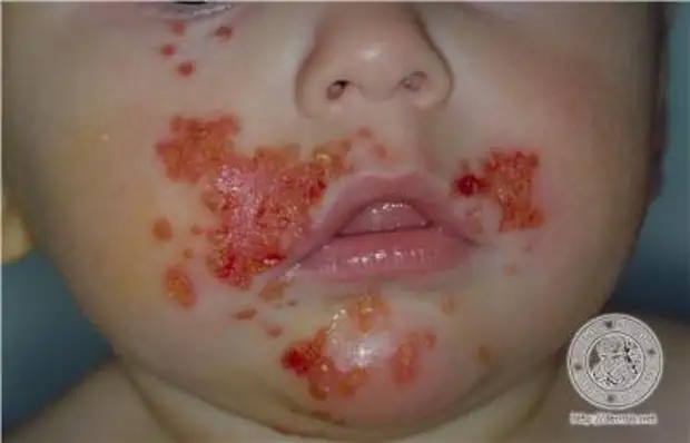 Thumela malunga ne-impetigo