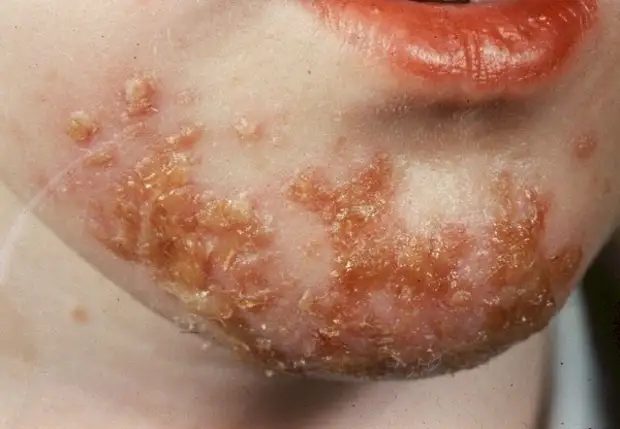 impetigo ਬਾਰੇ ਪੋਸਟ ਕਰੋ