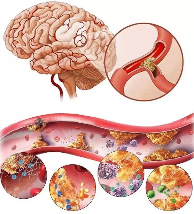 Баш мие тамырларының атеросклерозы: сәбәпләр