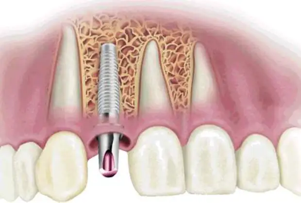 Dental implants: a short but necessary educational program