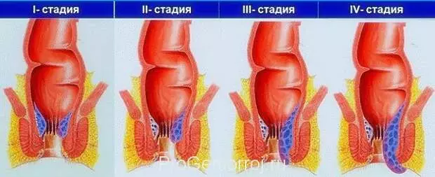 Ama-hemorrhoids. Ukubhekana nesifo