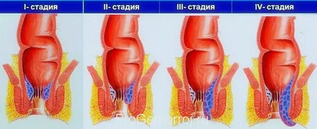 Οι αιμορροΐδες έχουν 4 στάδια ανάπτυξης. Η έγκαιρη έναρξη της θεραπείας αποτελεί εγγύηση ανάκαμψης.