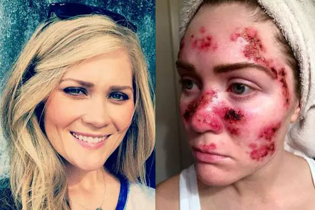 Selfie cu o fată cu cancer de piele pentru iubitorii de bronzare