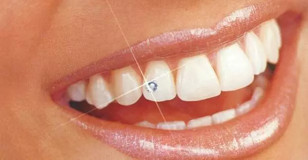 Gems for teeth