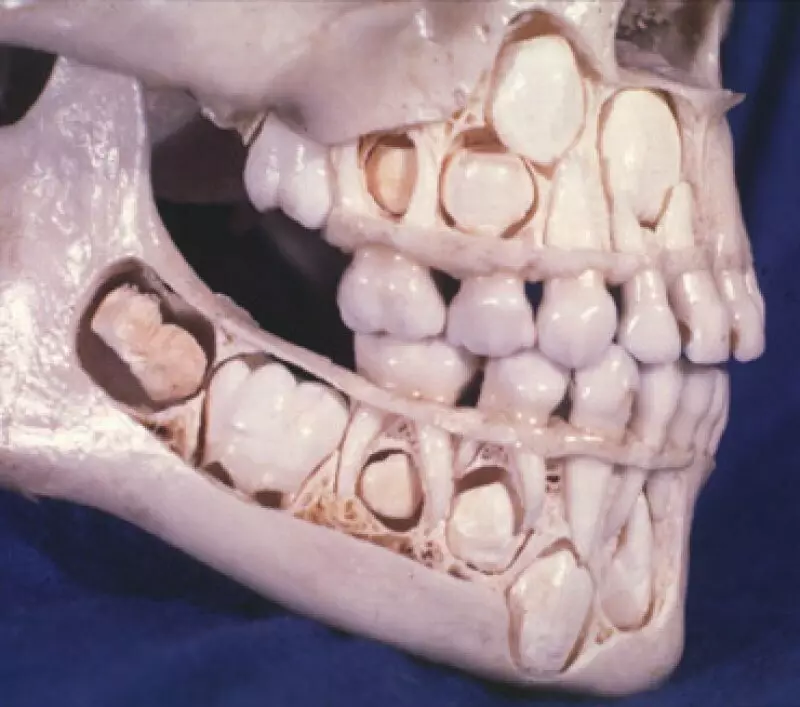 13. O cranio do neno ata o cambio de dentes de leite a permanente