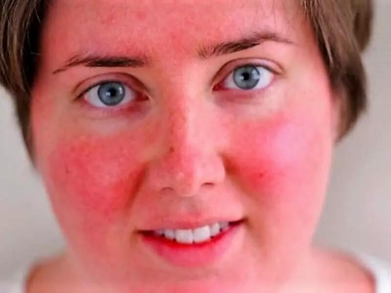 Factores externos que provocan vermelhidão facial sen temperatura