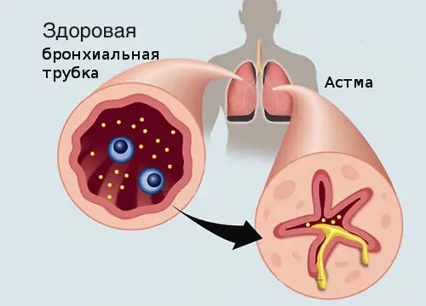 10 อาหารสำหรับโรคหอบหืด