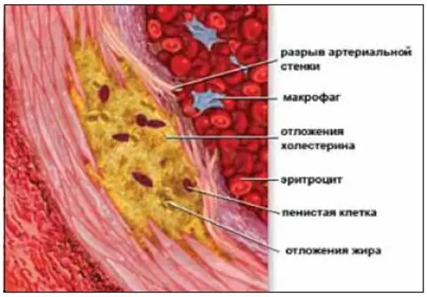 Léčba aterosklerózy doma