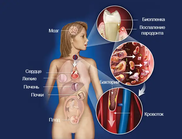 Periodontitis နှင့် rheumatoid အဆစ်အမြစ်ရောင်ခြင်း- လင့်ခ်ရှိပါသလား။