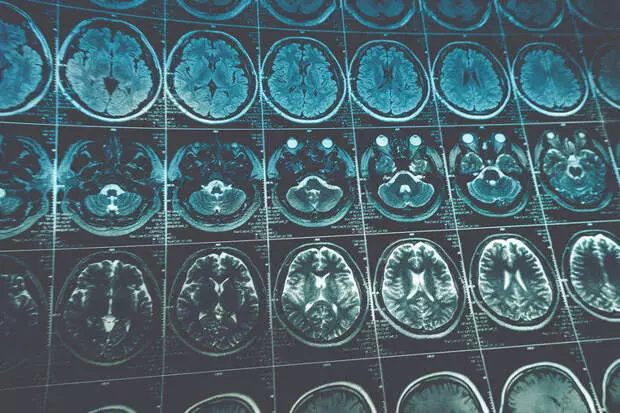 9 mitova o tumoru mozga u koje ne biste trebali vjerovati