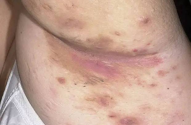 Hónalji hidradenitis