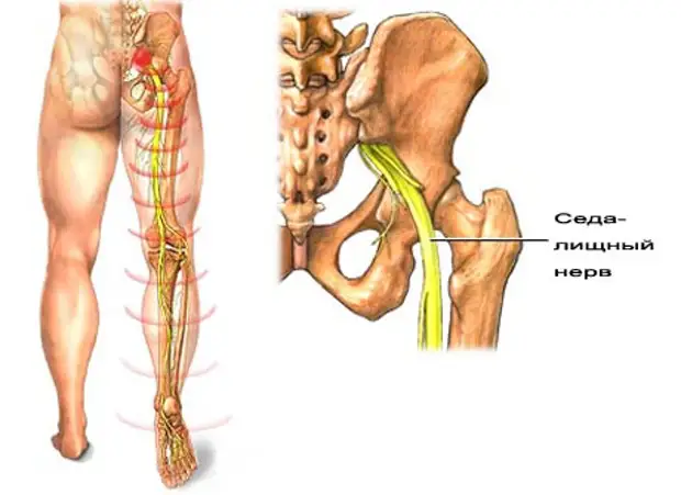 sciatic nerve kuzvimba