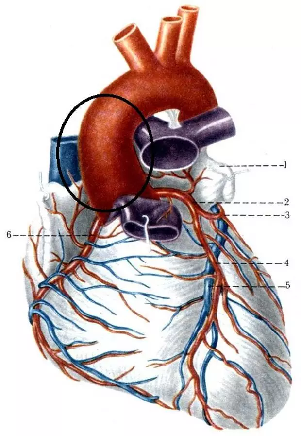 Aortic aneurysm