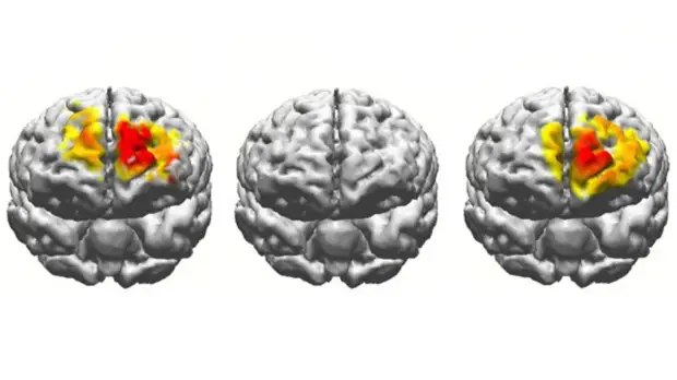 Attività cerebrale durante un test della memoria di lavoro. A sinistra: il cervello di un partecipante di 20 anni. Centro: il cervello di un partecipante di 70 anni. A destra è il cervello della stessa persona anziana dopo la stimolazione elettrica.