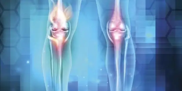 How arthritis differs from arthrosis
