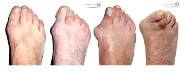 "Mga bukog" sa mga tiil o hallux valgus