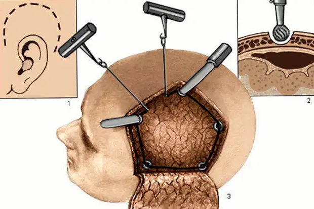 طب جراحات المخ ، طب ، مخ ، عملية ، بريد طويل ، نص ، صور ، قصدير