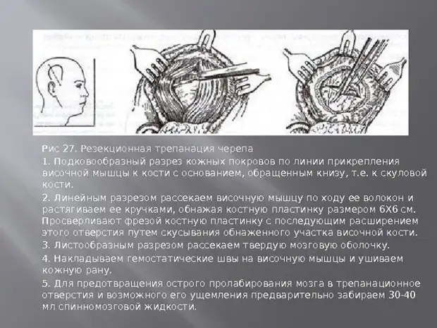 뇌 수술 의학, 뇌, 수술, Longpost, 텍스트, 그림, 주석