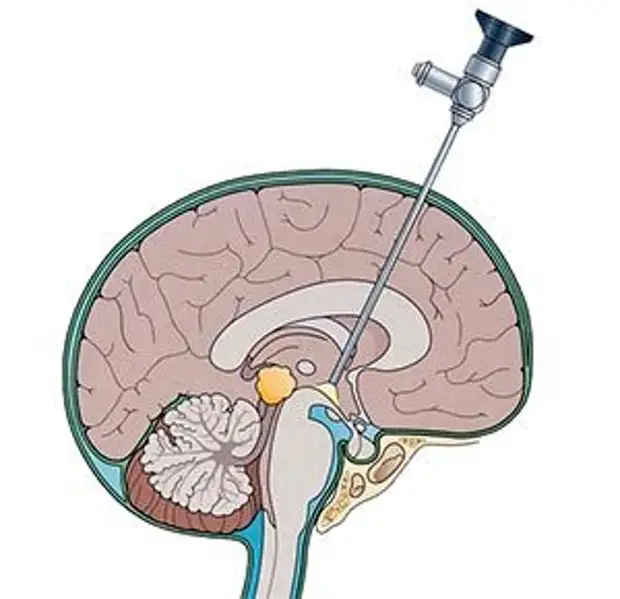 طب جراحات المخ ، طب ، مخ ، عملية ، بريد طويل ، نص ، صور ، قصدير