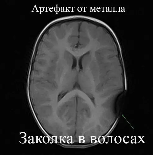 Je, MRI inaweza kufanywa kwenye chuma kwenye mwili? (kuchanganua) MRI, Tomography, Uchunguzi, Dawa, Meno, Utambuzi, Teknolojia, Video, Chapisho refu