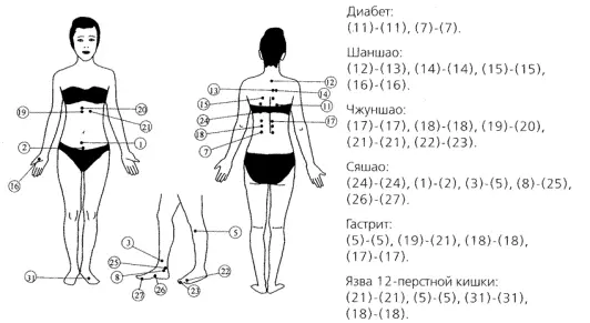 diabetes, gastritis, wlser duodenal; pwyntiau biolegol weithredol - Shangshao, - Zhongshao.