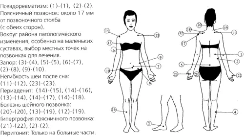 pseudo-rheumatism, sembelit, kekakuan leher selepas tidur, periadenitis, penyakit vertebra serviks, hipertrofi vertebra lumbar, peritonitis: hanya pada bahagian yang berpenyakit.