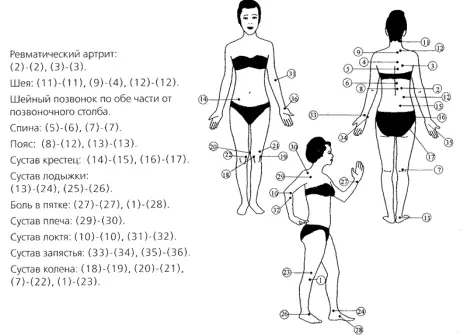 rheumatoid arthritis, leher, belakang, tali pinggang, sendi sakrum, sendi buku lali, sakit tumit, sendi bahu, sendi siku, sendi pergelangan tangan, sendi lutut.