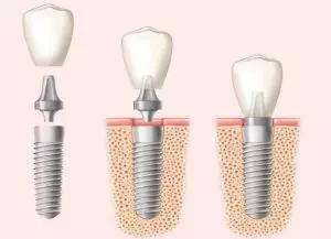 Dental implants: matang, timailhan, bahin