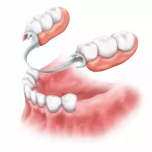 Implanturi dentare: tipuri, indicații, caracteristici