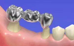 Implantes dentales: tipos, indicaciones, características.