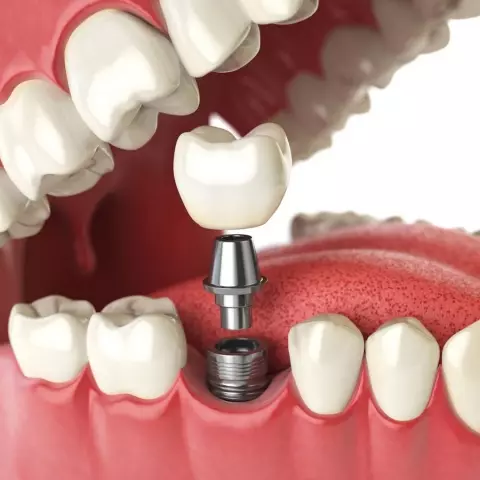 Implantes dentales: tipos, indicaciones, características.