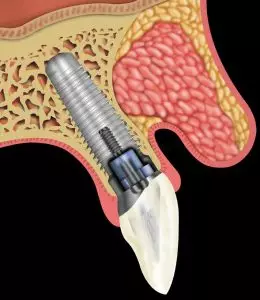 Dental implants: matang, timailhan, bahin