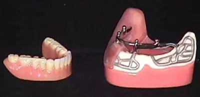 Implantes dentales: tipos, indicaciones, características.