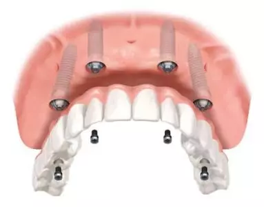 Implanturi dentare: tipuri, indicații, caracteristici