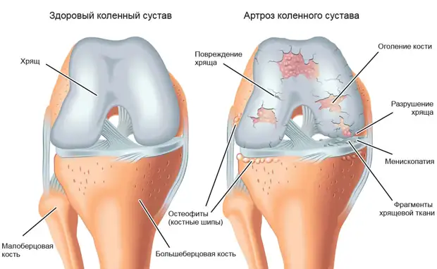 Тинктурата на дядо ми спаси коленете ми - болката изчезна и няма да се върне!