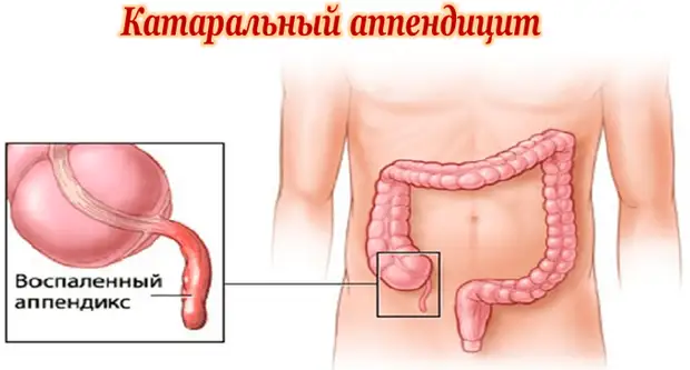 Catarrhal appendicitis