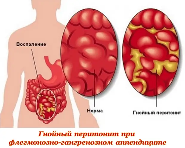 Peritonite com apendicite