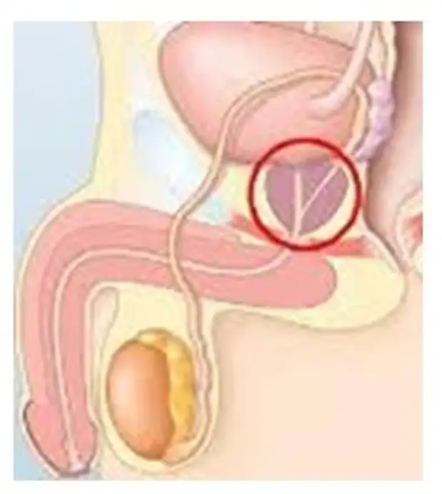 Простатит жөнүндө - жөнөкөй тил менен айтканда
