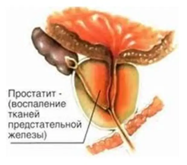 Относно простатита - с прости думи