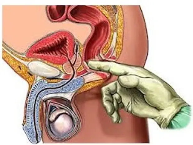 Простатит жөнүндө - жөнөкөй тил менен айтканда