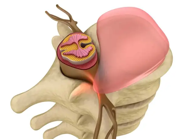 Cara ngobati protrusi cakram lumbar