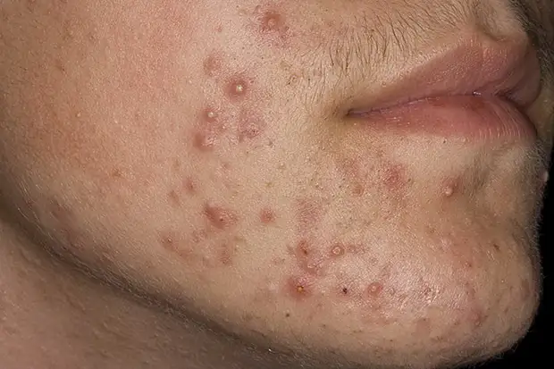 Acne verslaan: je gezicht wassen en diëten helpt vaak niet