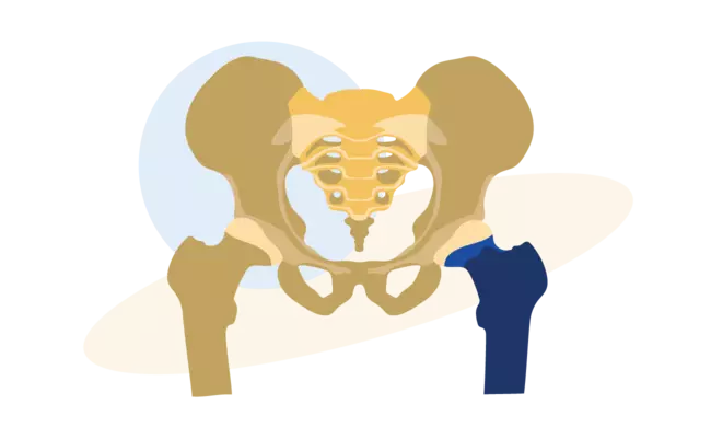 Pourquoi les personnes âgées se cassent-elles souvent les cuisses ? Et comment pouvez-vous éviter cela?