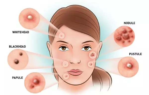 acne مان نجات حاصل ڪرڻ