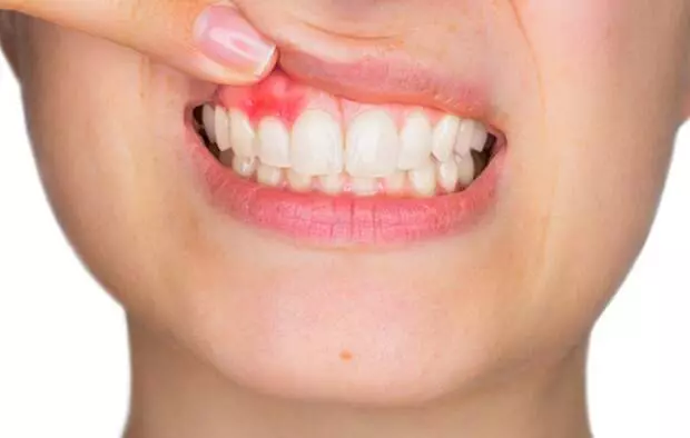 Kako ne izgubiti zdravih zob in zakaj se parodontalna bolezen ne sme sprožiti? Razlogi, preprosti nasveti za izboljšanje zdravja