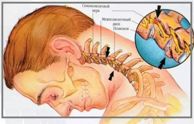 Servikal osteokondroz üçün bir sıra məşqlər, hətta kəskin ağrı ilə də edə bilərsiniz