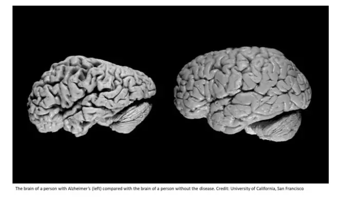 Il morbo di Alzheimer