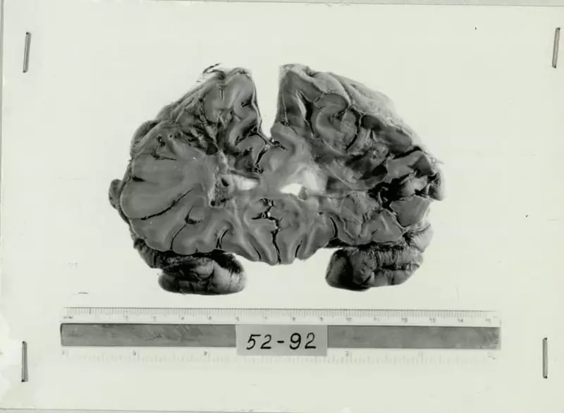 Apa lobus frontal otak yang bertanggung jawab atas penyakit mental, riwayat pengobatan, lobotomi, operasi?